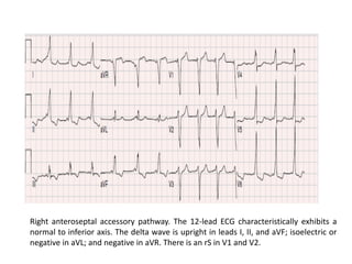 Localization of WPW( accessory Pathway) by surface ECG | PPT