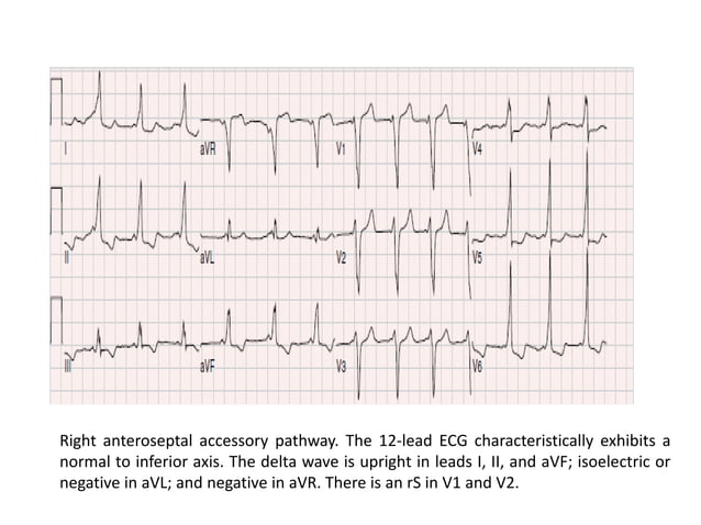 Localization of WPW( accessory Pathway) by surface ECG | PPT