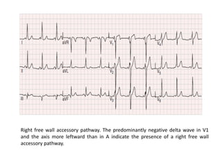 Localization of WPW( accessory Pathway) by surface ECG | PPT