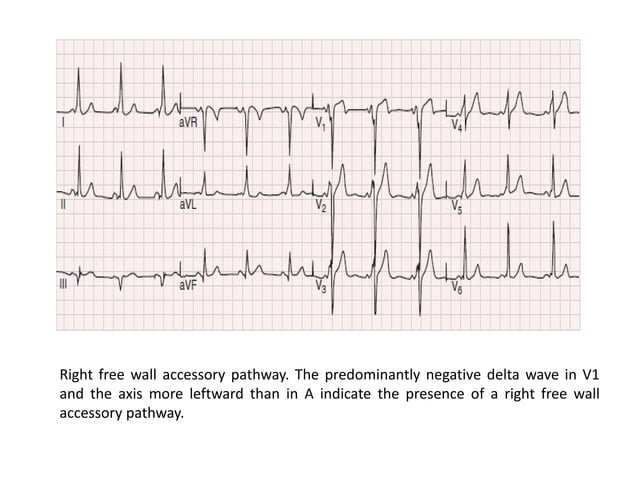 Localization of WPW( accessory Pathway) by surface ECG | PPT