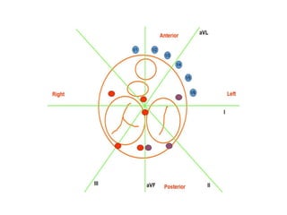Localization of WPW( accessory Pathway) by surface ECG | PPT