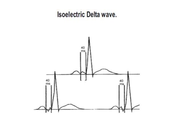 Localization of WPW( accessory Pathway) by surface ECG