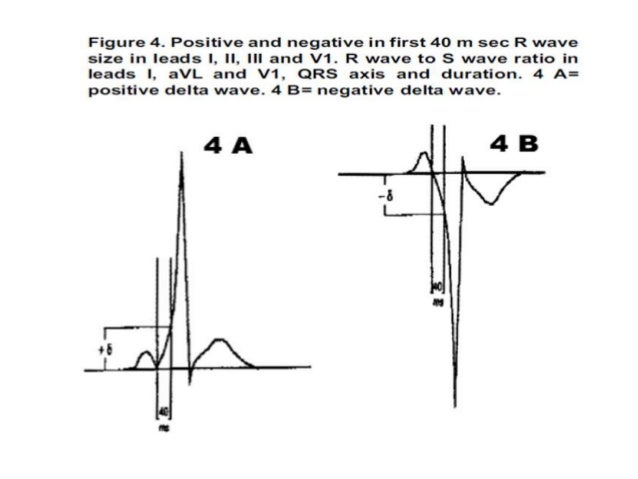 Localization of WPW( accessory Pathway) by surface ECG