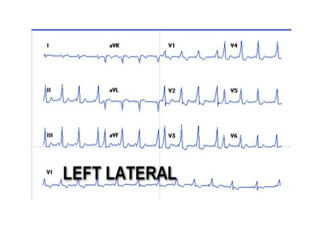 Localization of WPW( accessory Pathway) by surface ECG