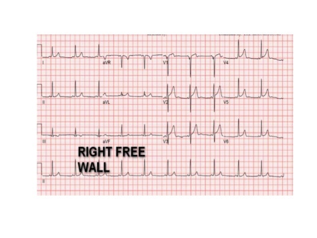 Localization of WPW( accessory Pathway) by surface ECG