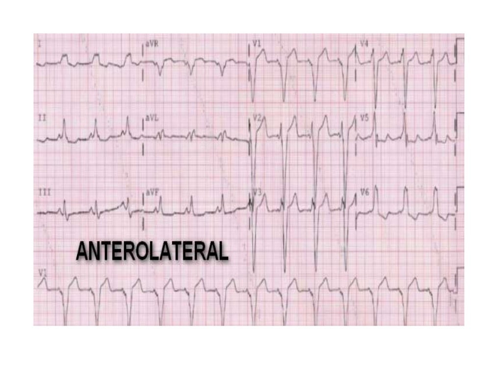 Localization of WPW( accessory Pathway) by surface ECG