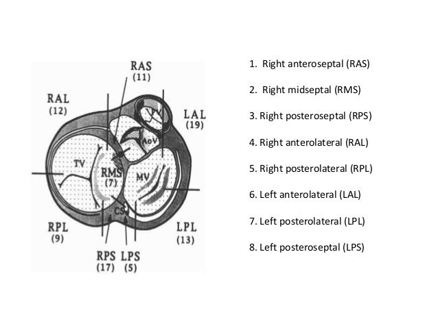 Localization of WPW( accessory Pathway) by surface ECG