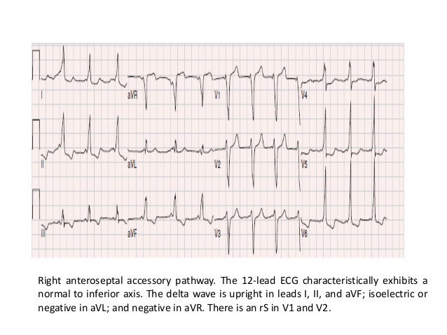 Localization Of Wpw Accessory Pathway By Surface Ecg
