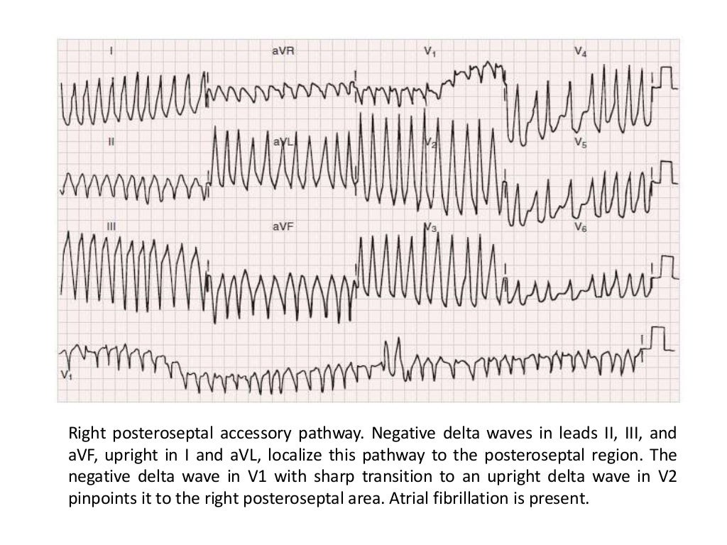 Localization of WPW( accessory Pathway) by surface ECG