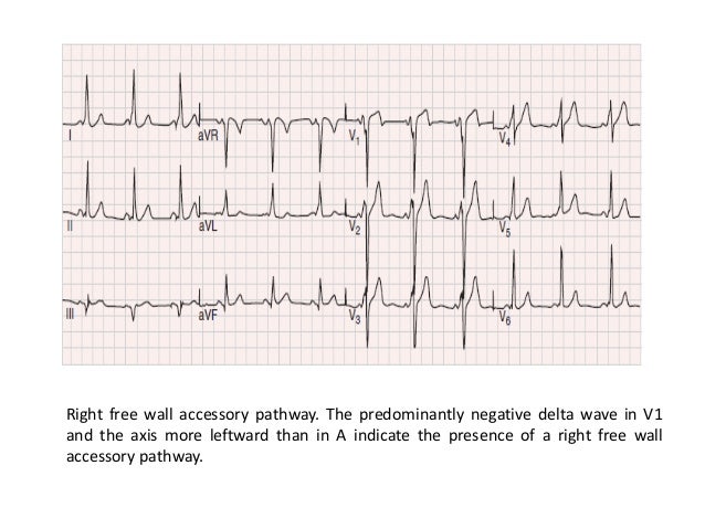 Localization of WPW( accessory Pathway) by surface ECG