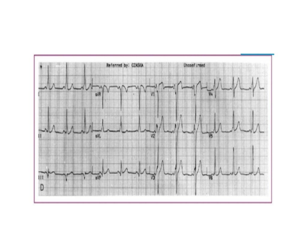 Localization Of Wpw Accessory Pathway By Surface Ecg