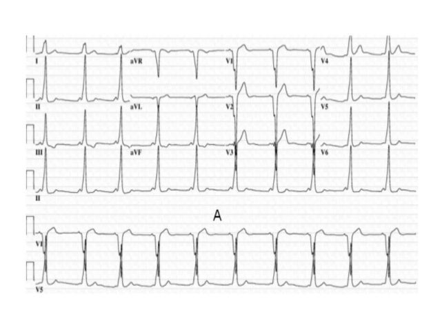 Localization of WPW( accessory Pathway) by surface ECG
