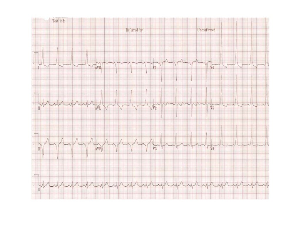 Localization Of Wpw Accessory Pathway By Surface Ecg