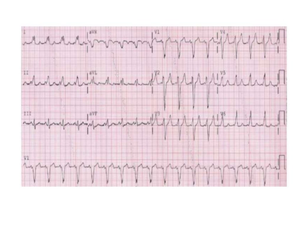 Localization of WPW( accessory Pathway) by surface ECG