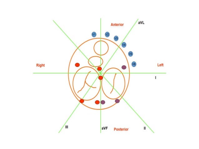 Localization of WPW( accessory Pathway) by surface ECG