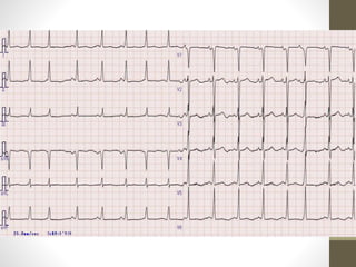 WPW syndrome | PPTX