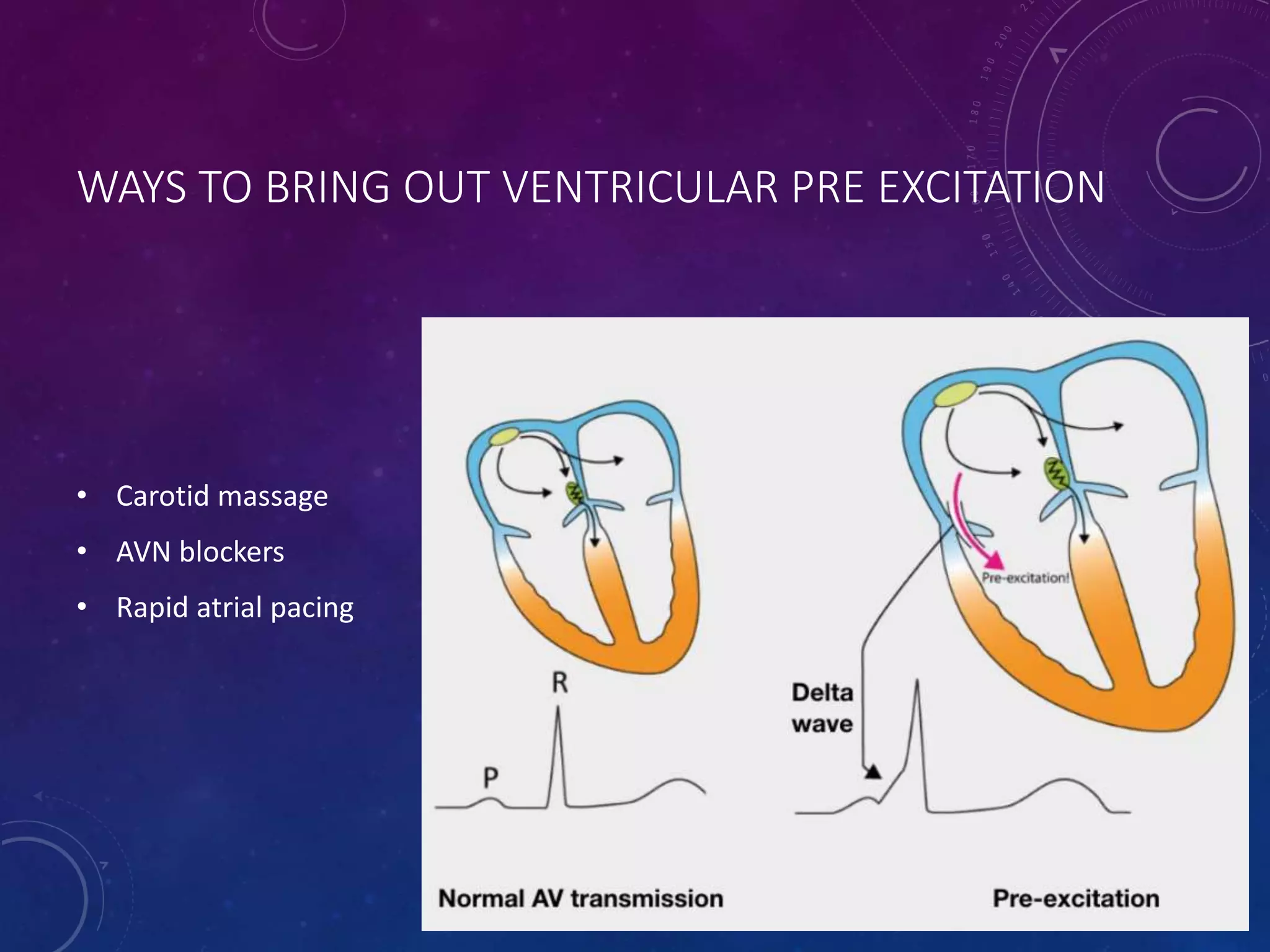 WPW EP evaluation | PPTX
