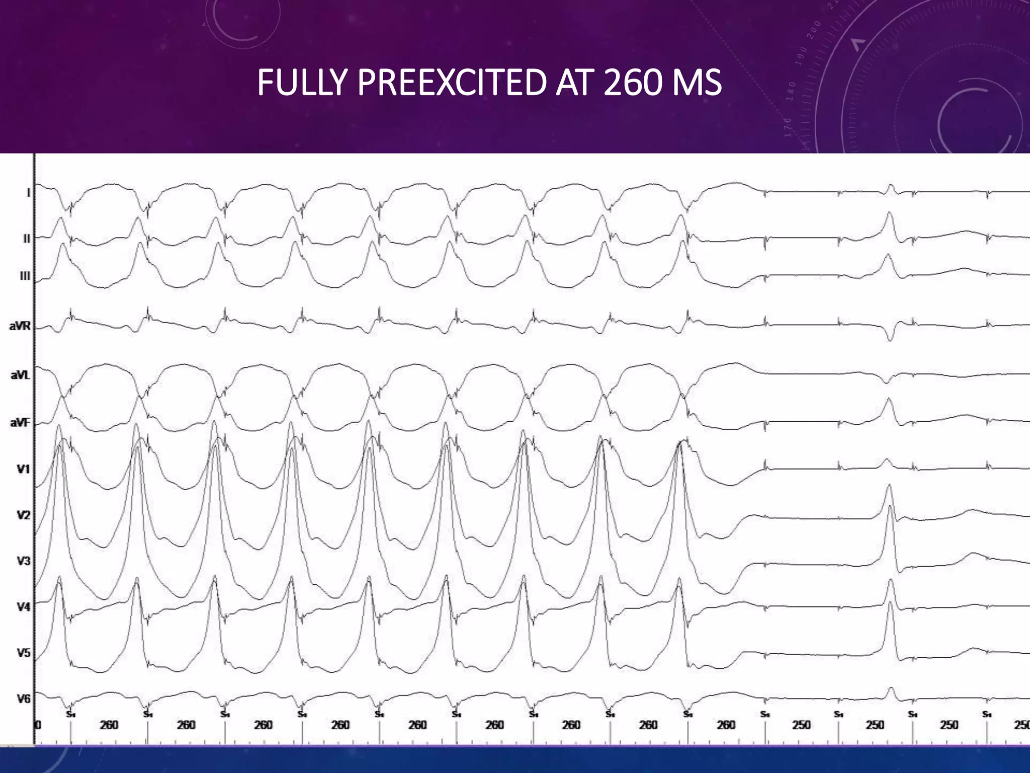 WPW EP evaluation | PPTX