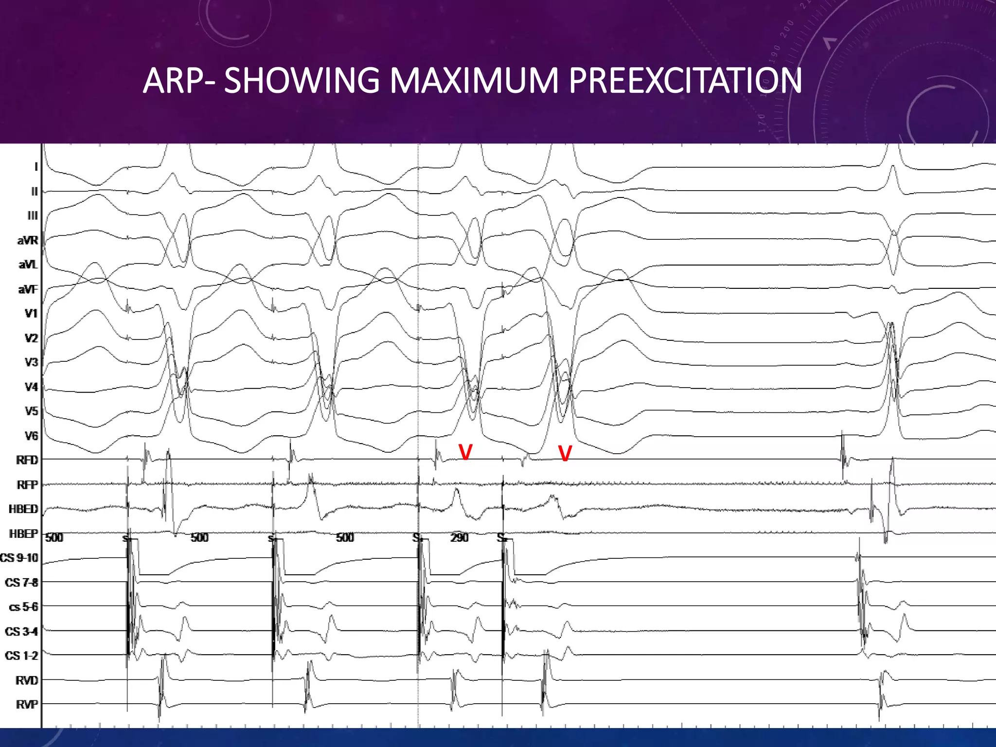 WPW EP evaluation | PPTX