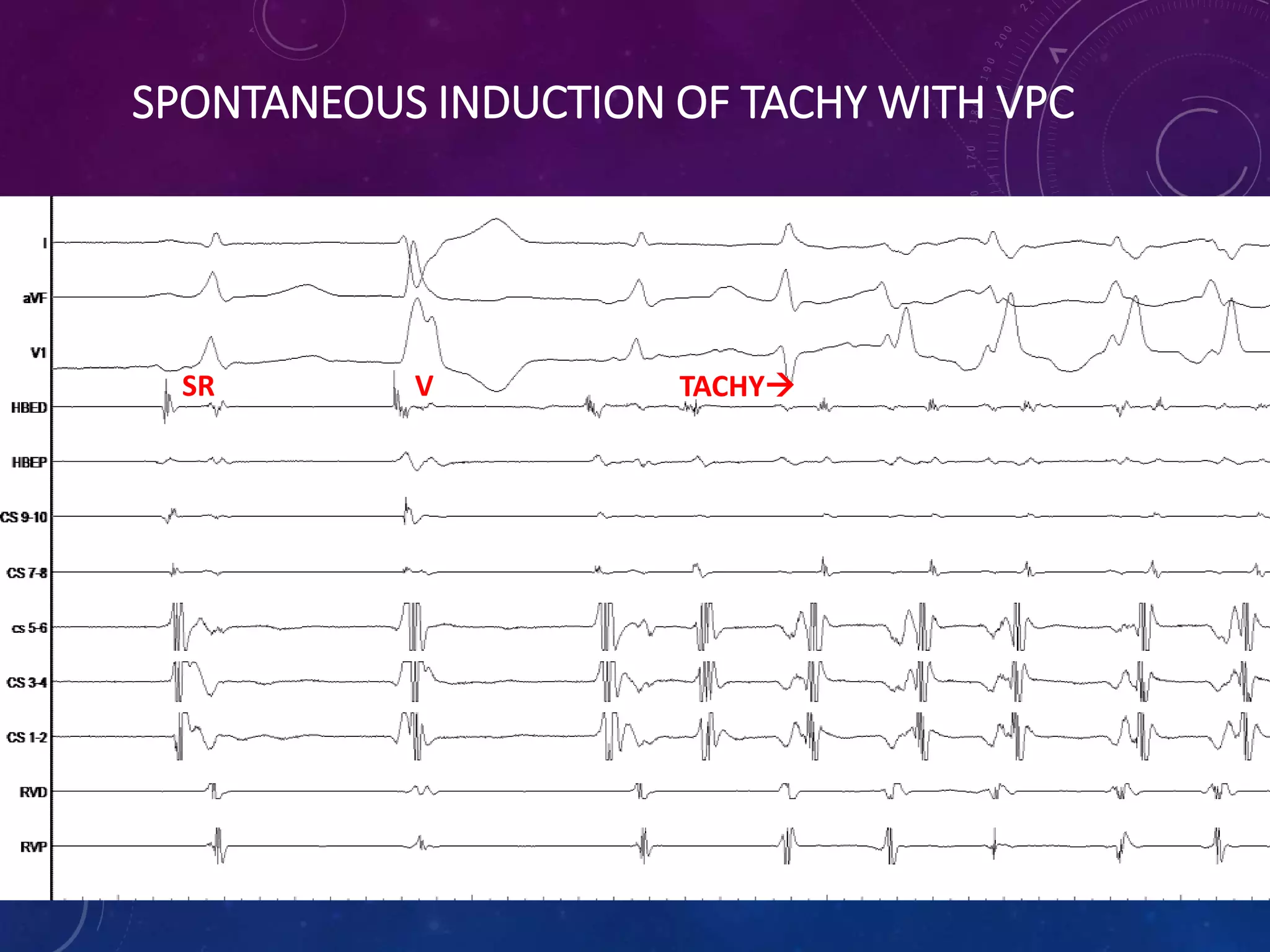 WPW EP evaluation | PPTX
