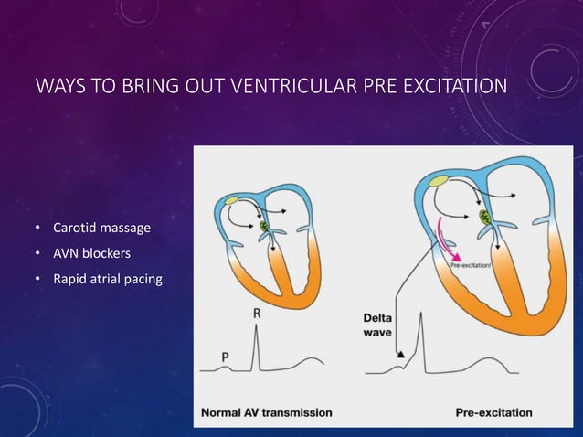 WPW EP evaluation | PPTX | Heart and Cardiovascular Diseases | Diseases ...