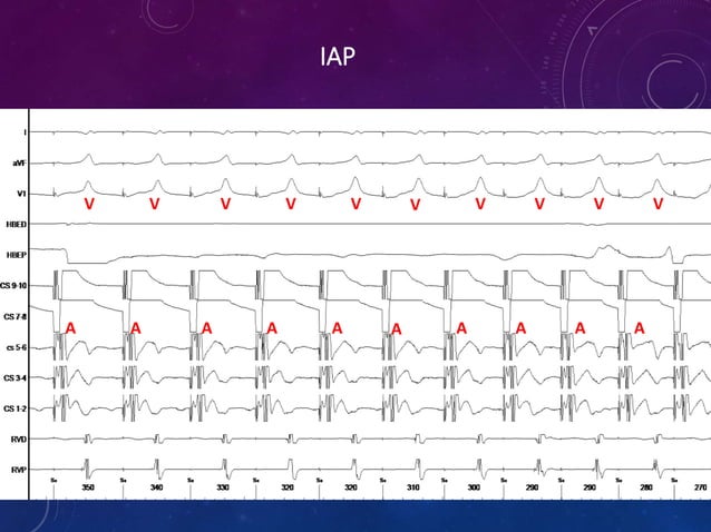 WPW EP evaluation | PPTX | Heart and Cardiovascular Diseases | Diseases ...