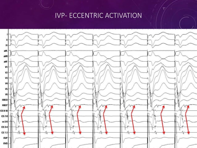 WPW EP evaluation | PPTX | Heart and Cardiovascular Diseases | Diseases ...
