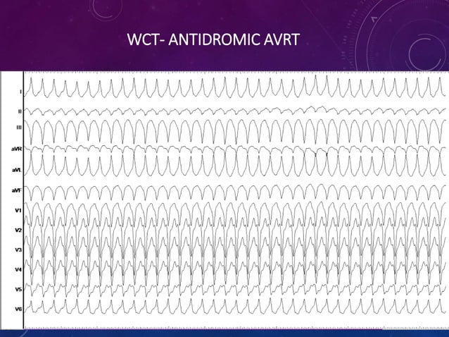 WPW EP evaluation | PPTX | Heart and Cardiovascular Diseases | Diseases ...