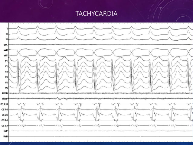 WPW EP evaluation | PPTX | Heart and Cardiovascular Diseases | Diseases ...