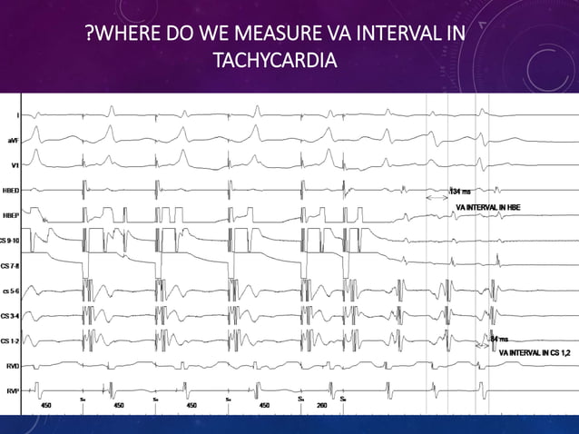 WPW EP evaluation | PPTX | Heart and Cardiovascular Diseases | Diseases ...
