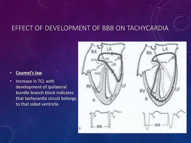 WPW EP evaluation | PPTX | Heart and Cardiovascular Diseases | Diseases ...