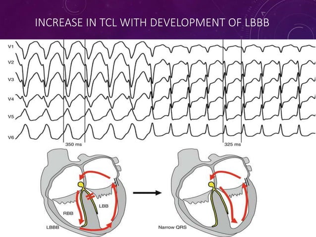 WPW EP evaluation | PPT