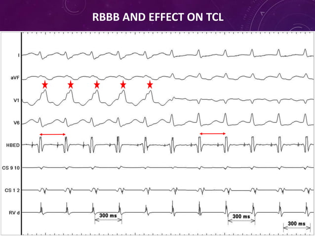 WPW EP evaluation | PPTX | Heart and Cardiovascular Diseases | Diseases ...