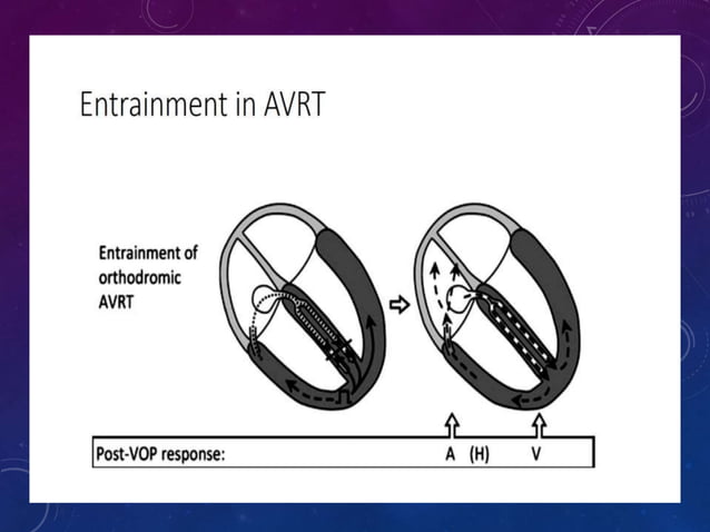 WPW EP evaluation | PPTX | Heart and Cardiovascular Diseases | Diseases ...