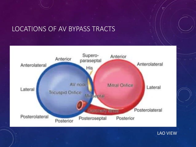 WPW EP evaluation | PPTX | Heart and Cardiovascular Diseases | Diseases ...