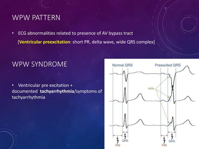 WPW EP evaluation | PPTX | Heart and Cardiovascular Diseases | Diseases ...