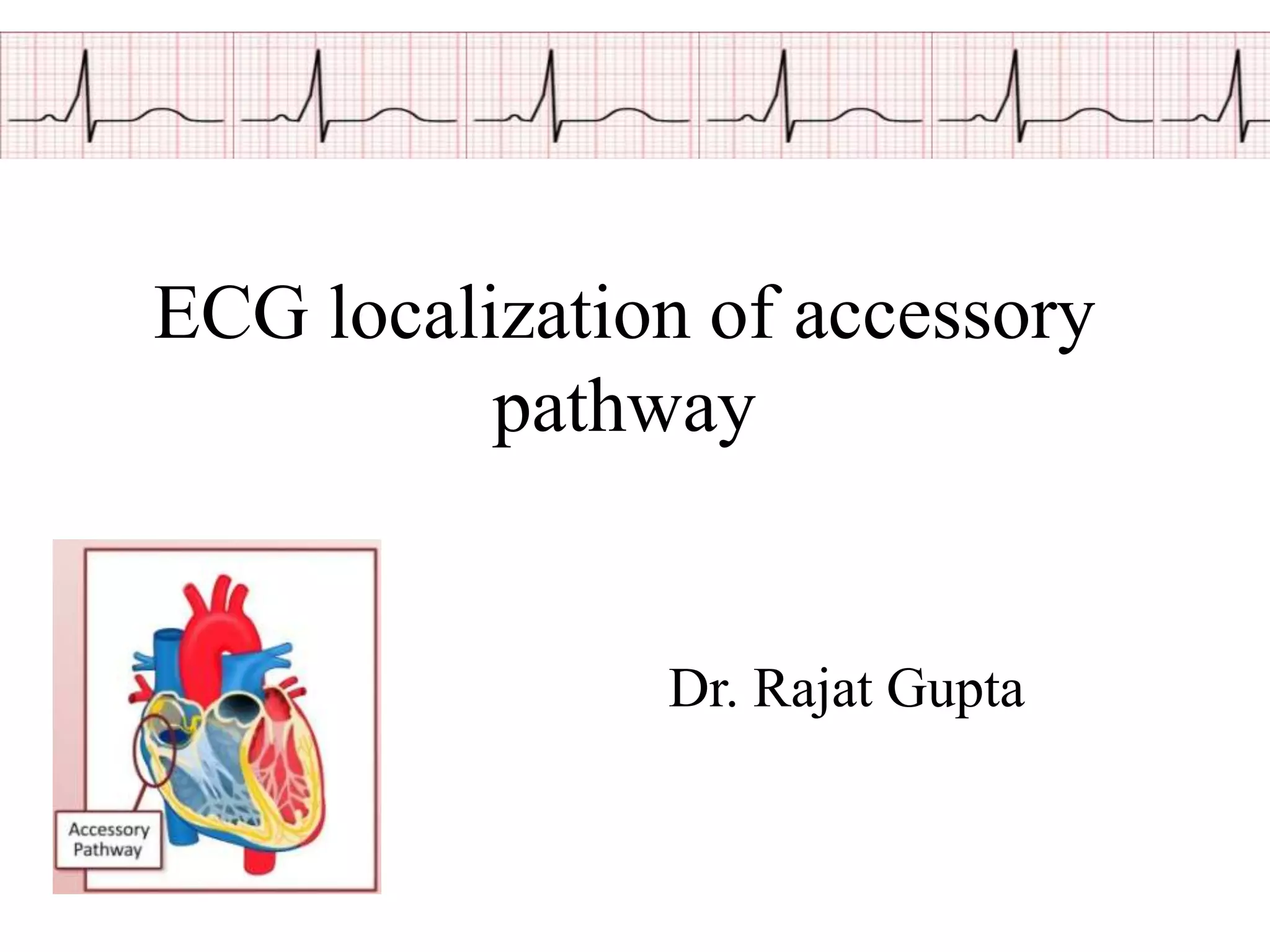 ECG localization of accessory pathways slideshare | PPTX
