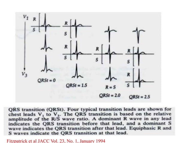 ECG localization of accessory pathways slideshare | PPTX