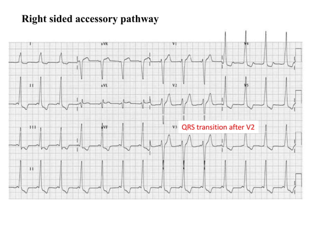 ECG localization of accessory pathways slideshare | PPTX