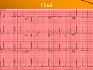 Case report_manifest WPW syndrome | PDF