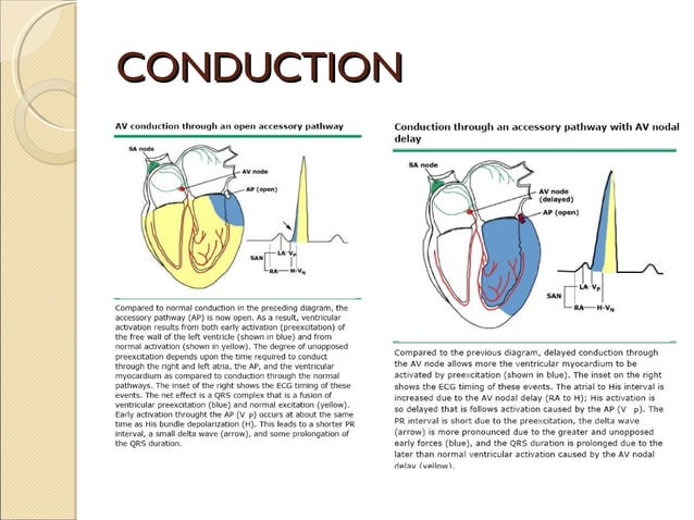 Wpw syndrome | PPT | Heart and Cardiovascular Diseases | Diseases and ...