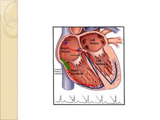 Bundle Of Kent Anatomy