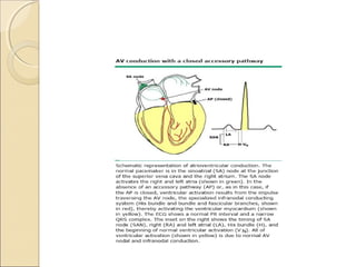 Bundle Of Kent Anatomy
