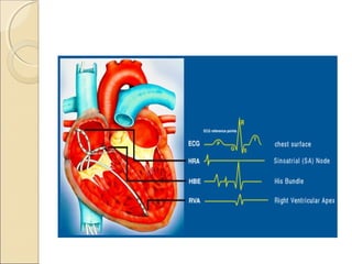 Bundle Of Kent Anatomy