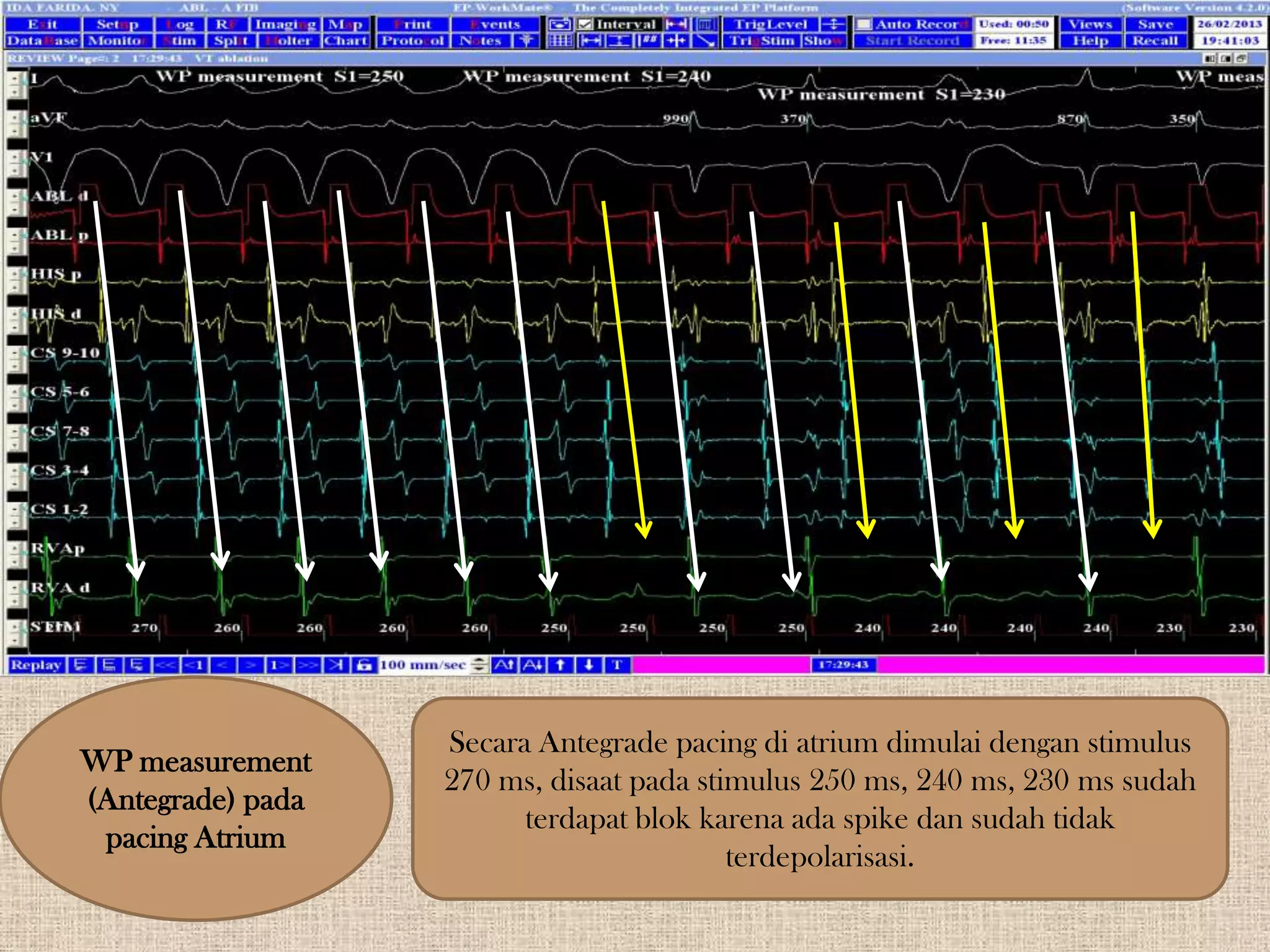 Wpw syndrome jadi | PPTX
