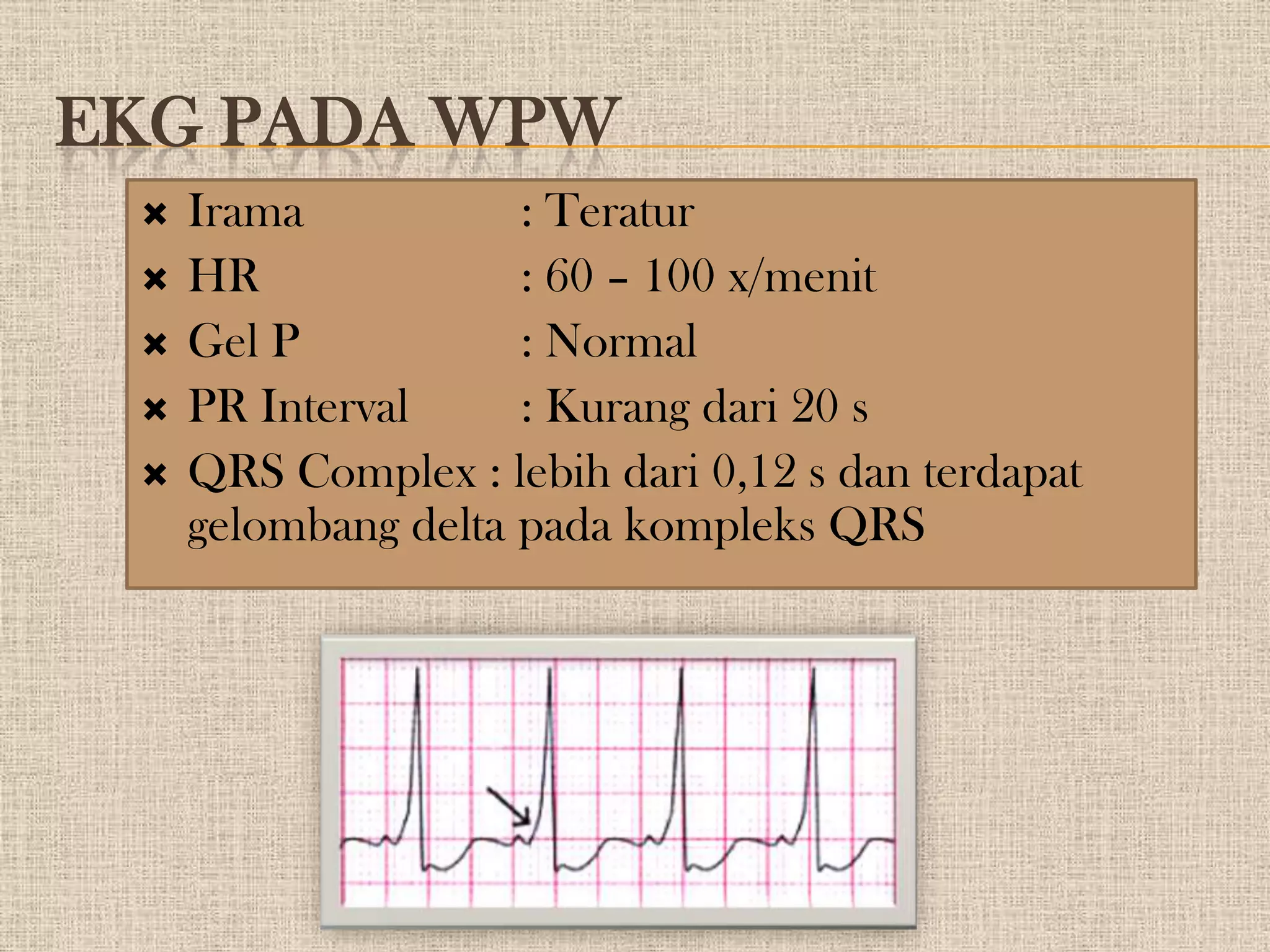 Wpw syndrome jadi | PPTX