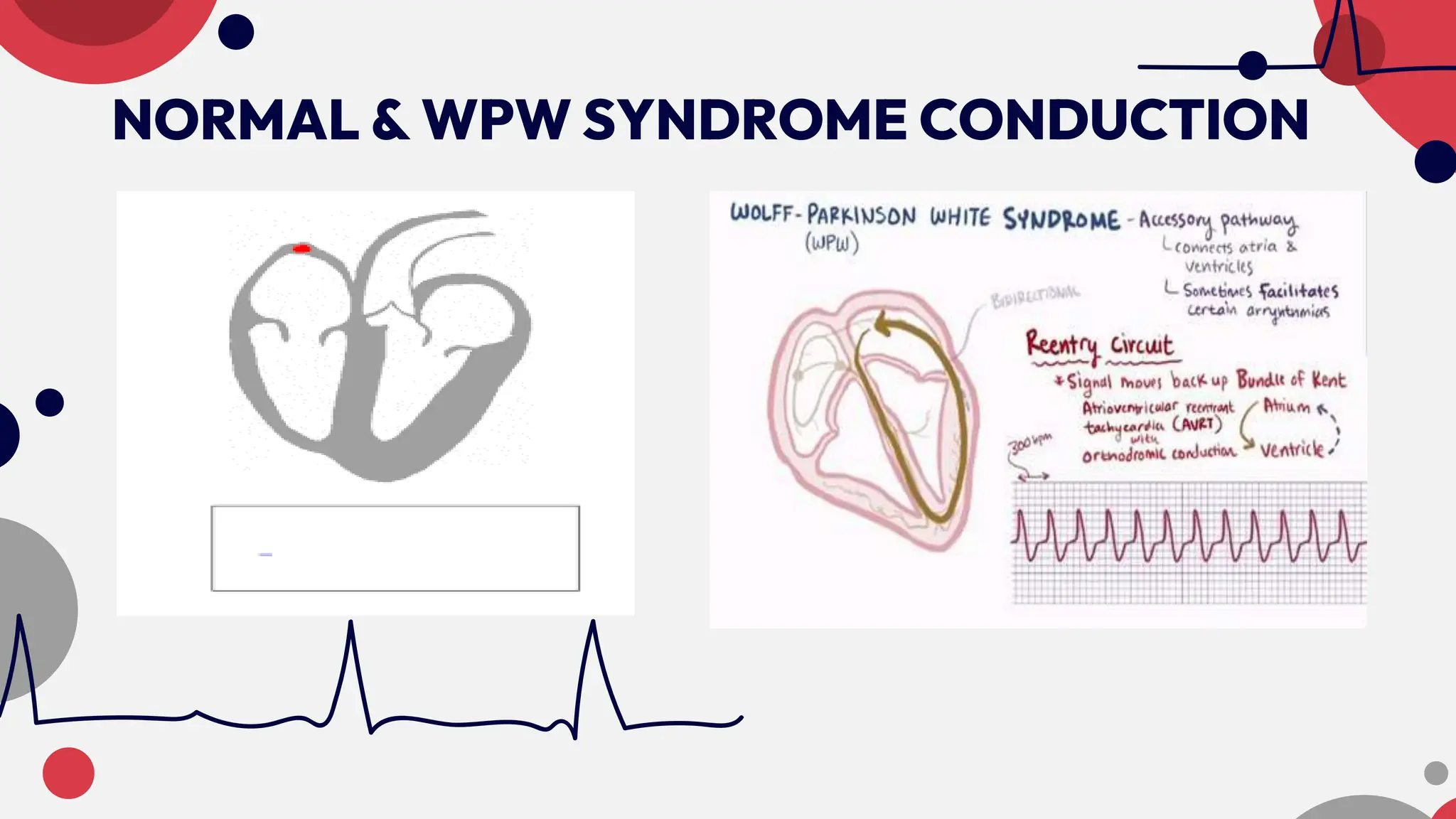 WPW SYNDROME pROJECT.pptx