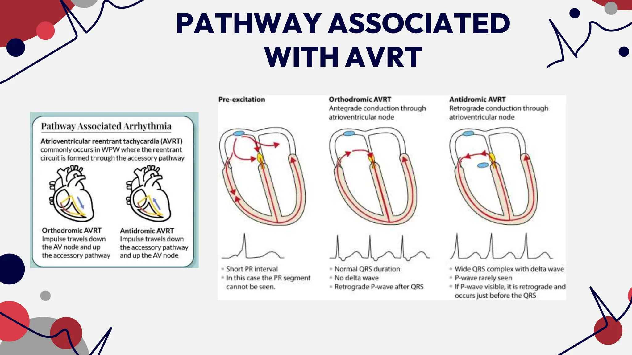 WPW SYNDROME pROJECT.pptx