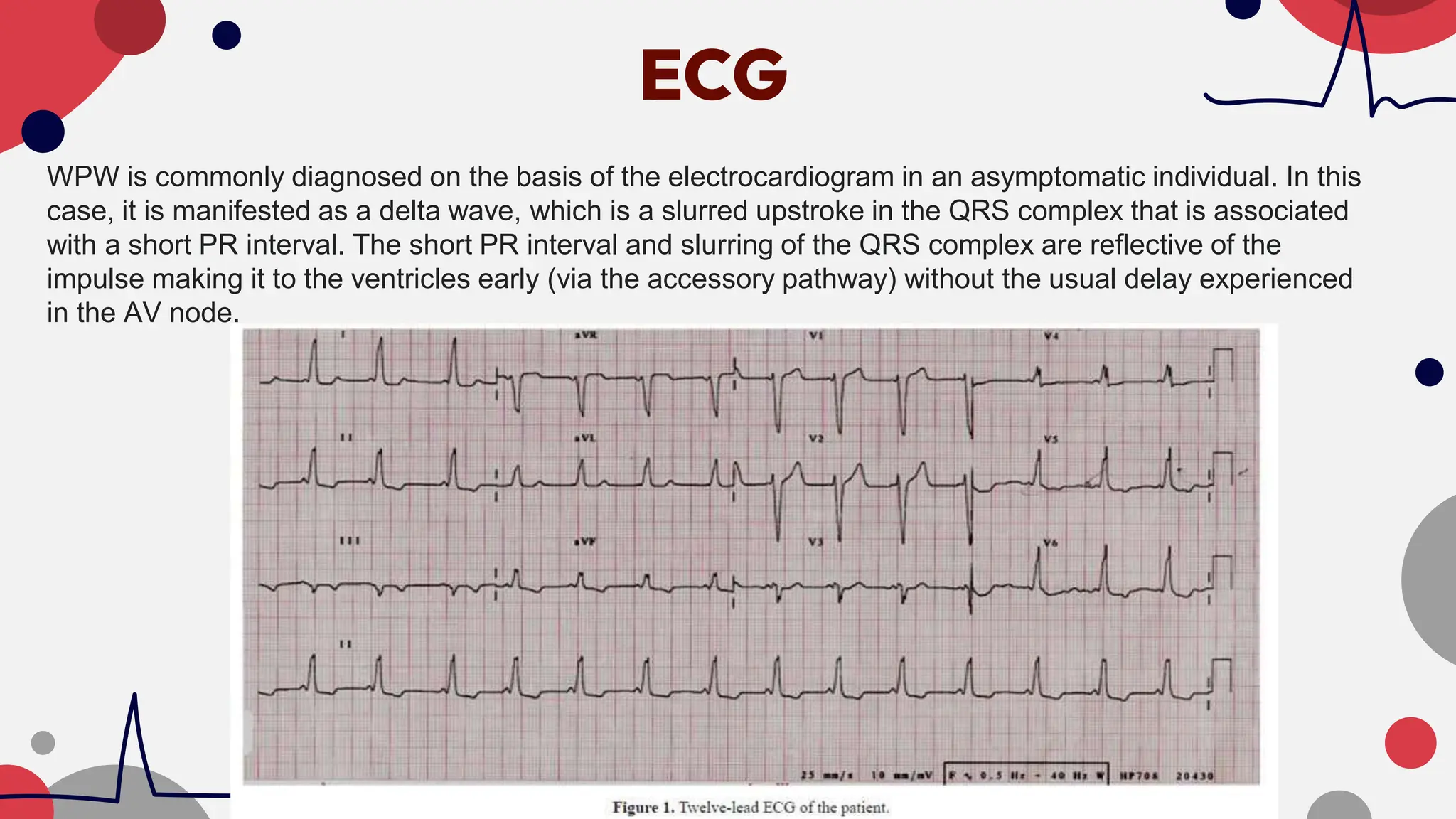 WPW SYNDROME pROJECT.pptx