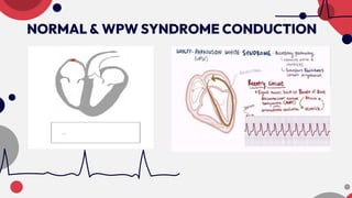 WPW SYNDROME pROJECT.pptx